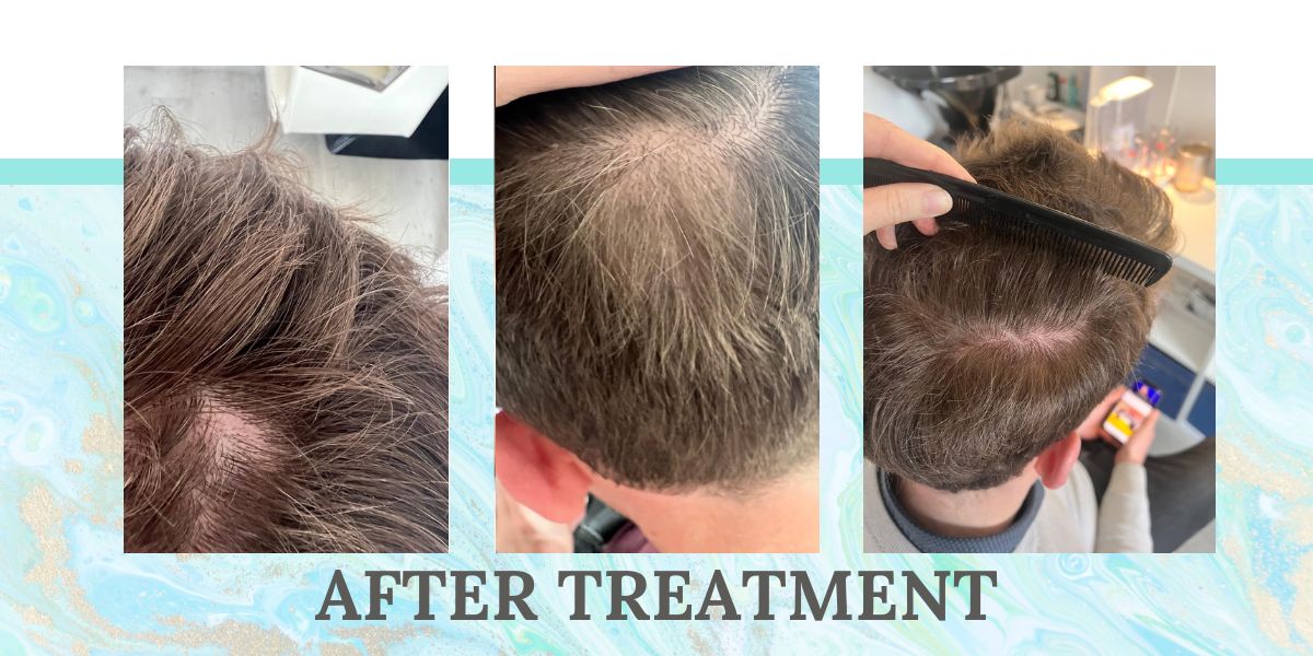 Alopecia Areata: Understanding the Causes, Symptoms, and Treatments ...